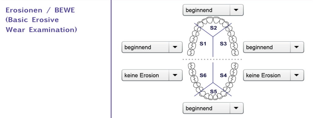 Der Angriff der Säuren … Dentale Erosionen – dental:spiegel