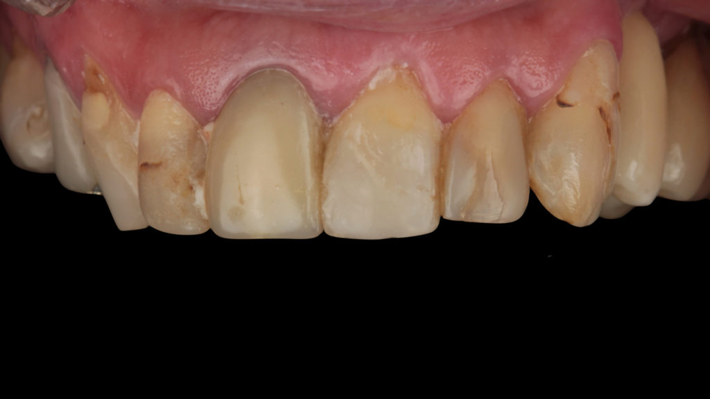 Die stärksten ihrer Art: Grandio blocs und Grandio disc – dental:spiegel