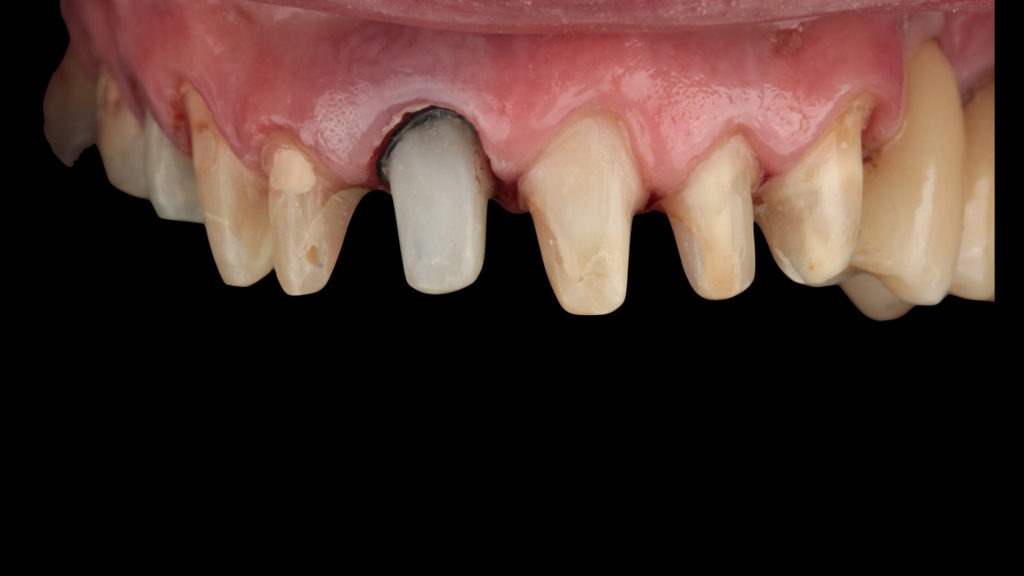 Die stärksten ihrer Art: Grandio blocs und Grandio disc – dental:spiegel