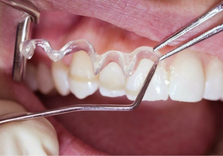 VOCO Clip® Flow – Das erste fließfähige Füllungsmaterial für temporäre Versorgungen – dental ...