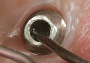 VOCO Clip® Flow – Das erste fließfähige Füllungsmaterial für temporäre ...