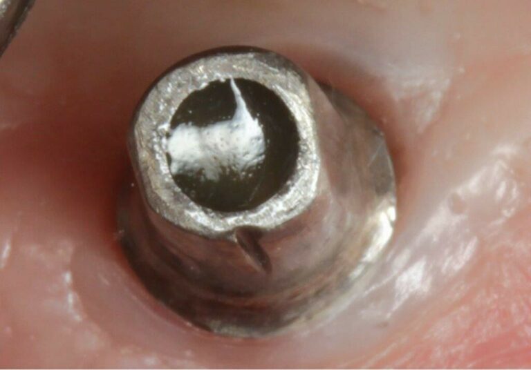 VOCO Clip® Flow – Das erste fließfähige Füllungsmaterial für temporäre ...