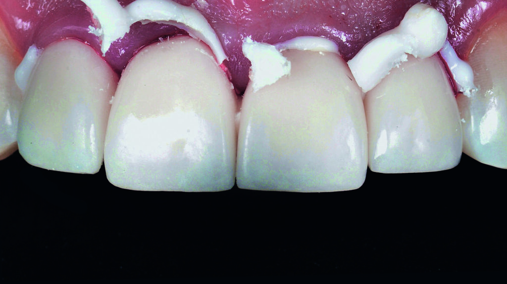 Provicol QM Aesthetic – Der transluzente temporäre Befestigungszement ...